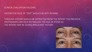Evaluation of ptosis | PPTX