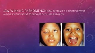 Evaluation of ptosis | PPTX