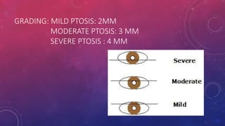 Evaluation of ptosis | PPT