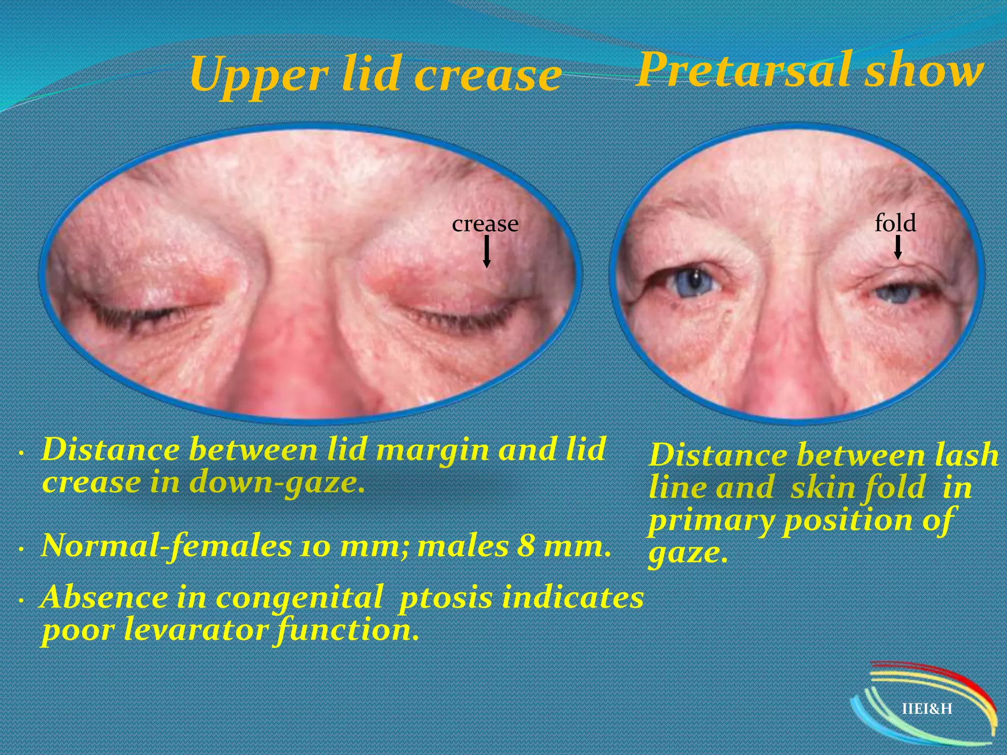 Ptosis workup | PPT