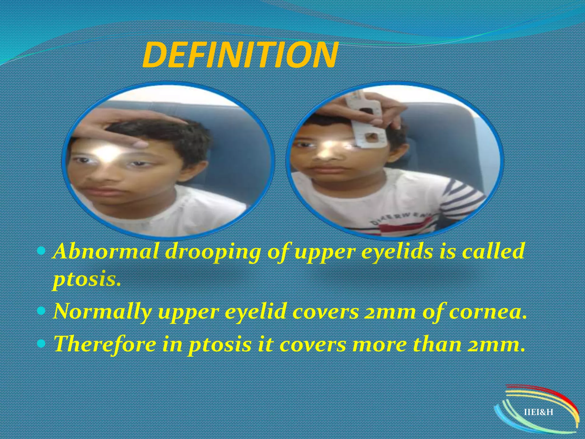 Ptosis workup | PPTX