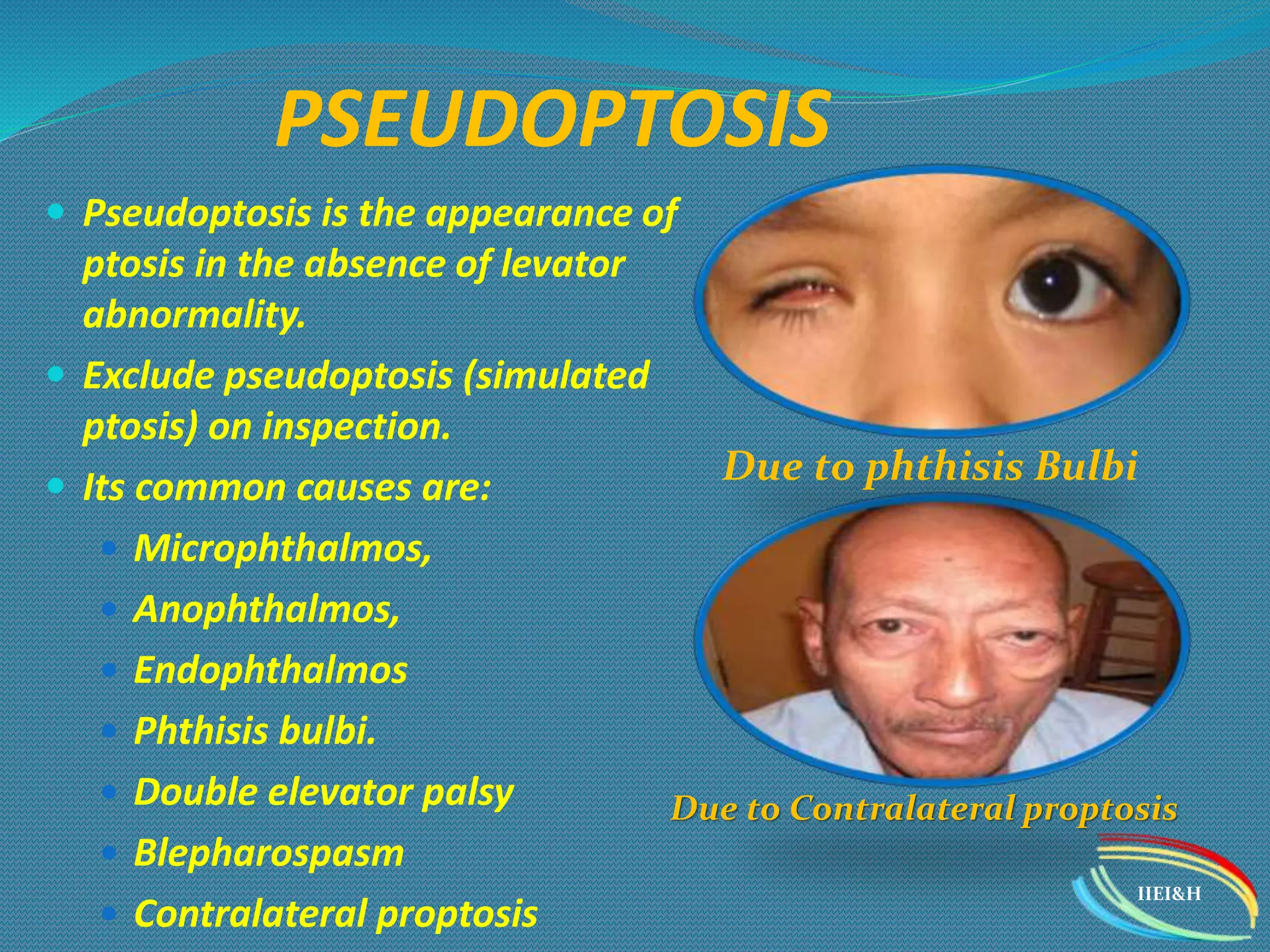 Ptosis workup | PPTX