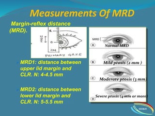 Ptosis workup | PPTX