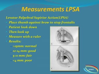 Ptosis workup | PPTX