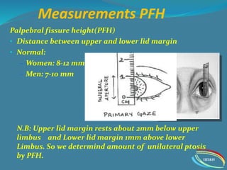 Ptosis workup | PPTX
