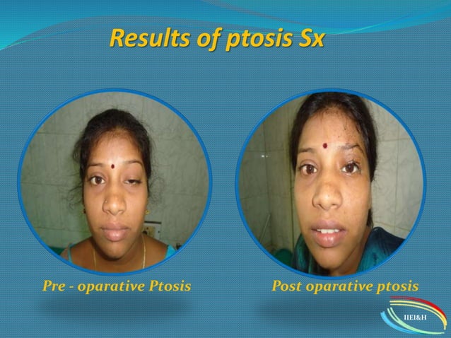 Ptosis workup | PPTX