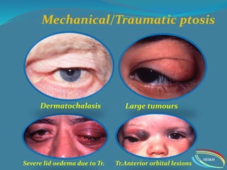 Ptosis workup | PPTX