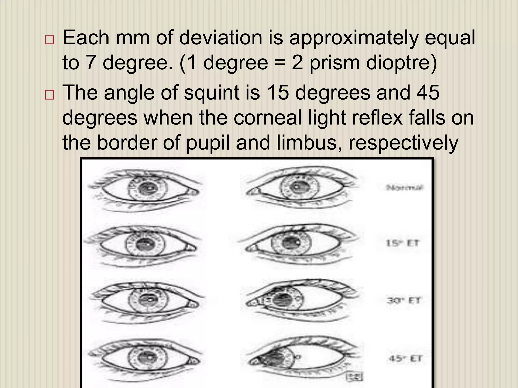 Evaluation of squint | PPTX