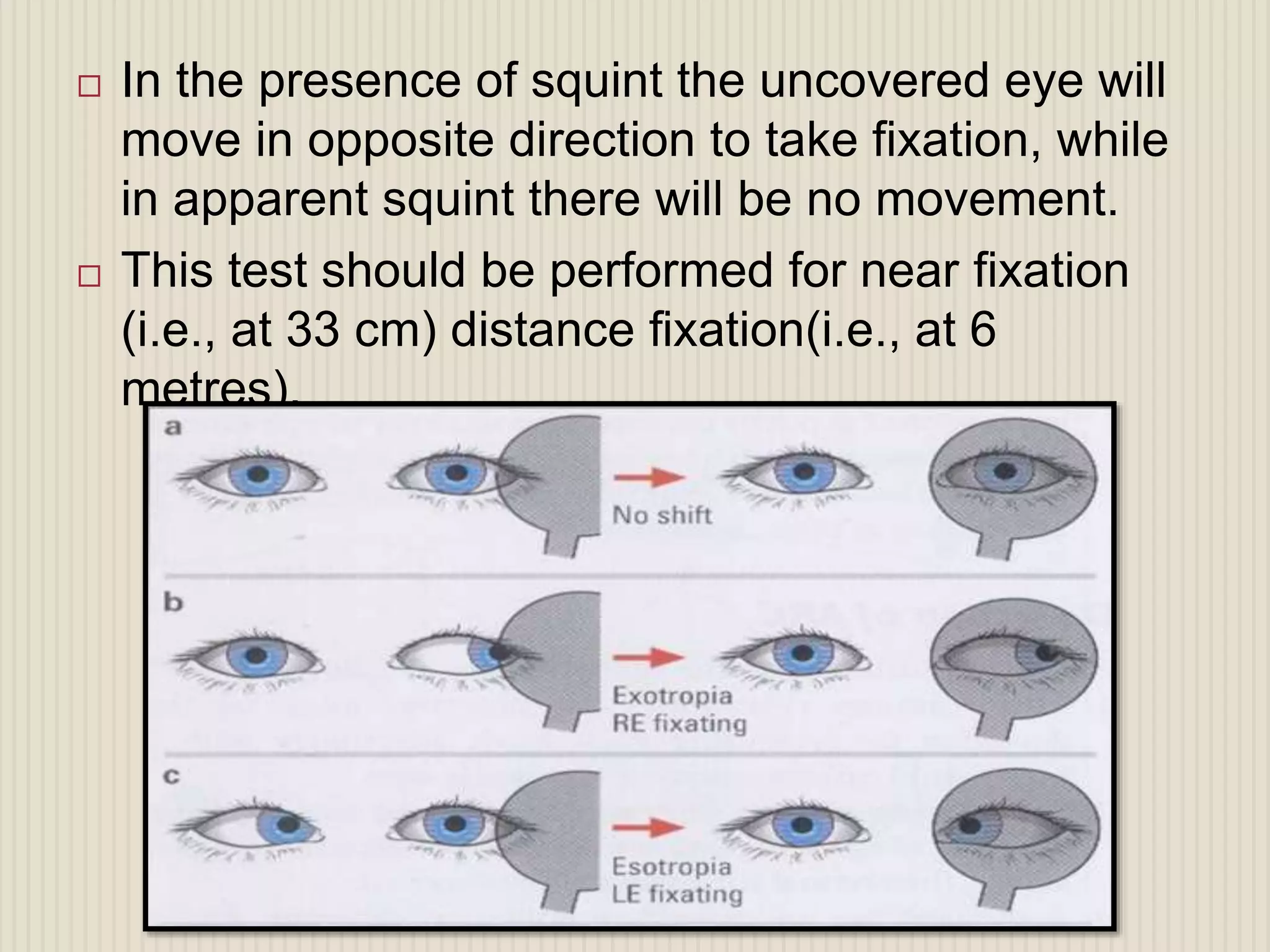 Evaluation of squint | PPTX