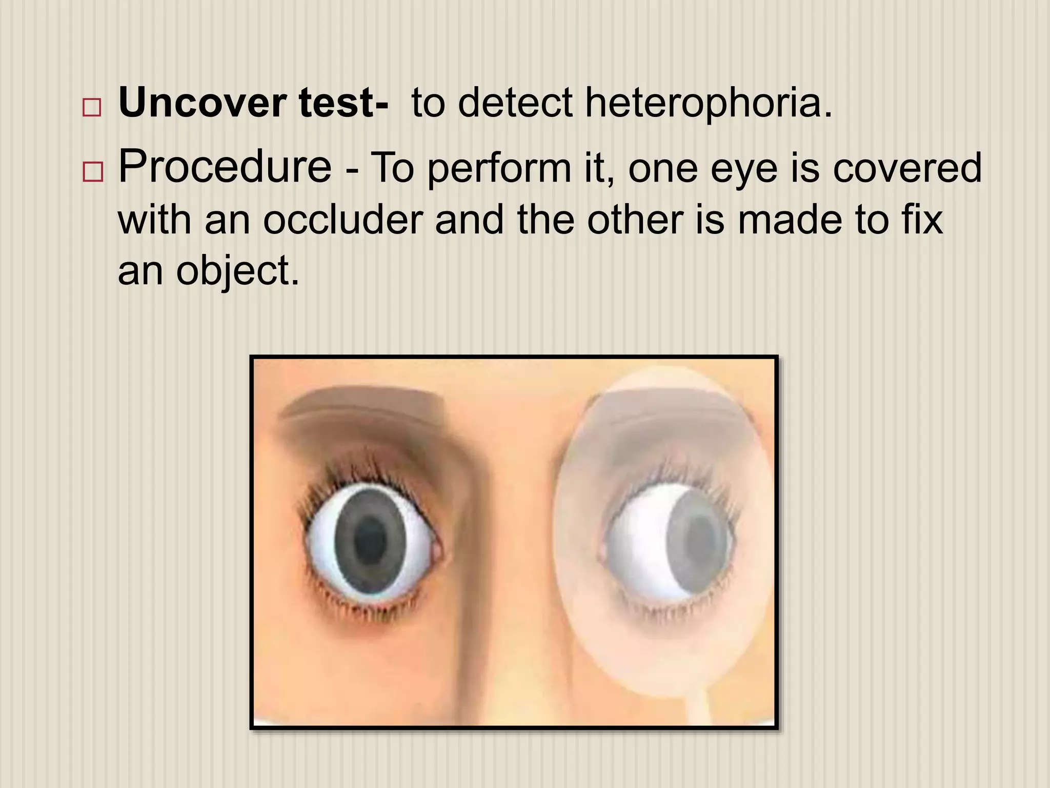 Evaluation of squint | PPTX