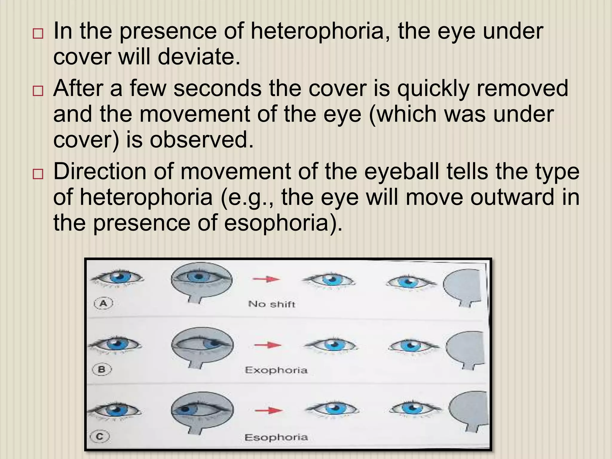 Evaluation of squint | PPTX