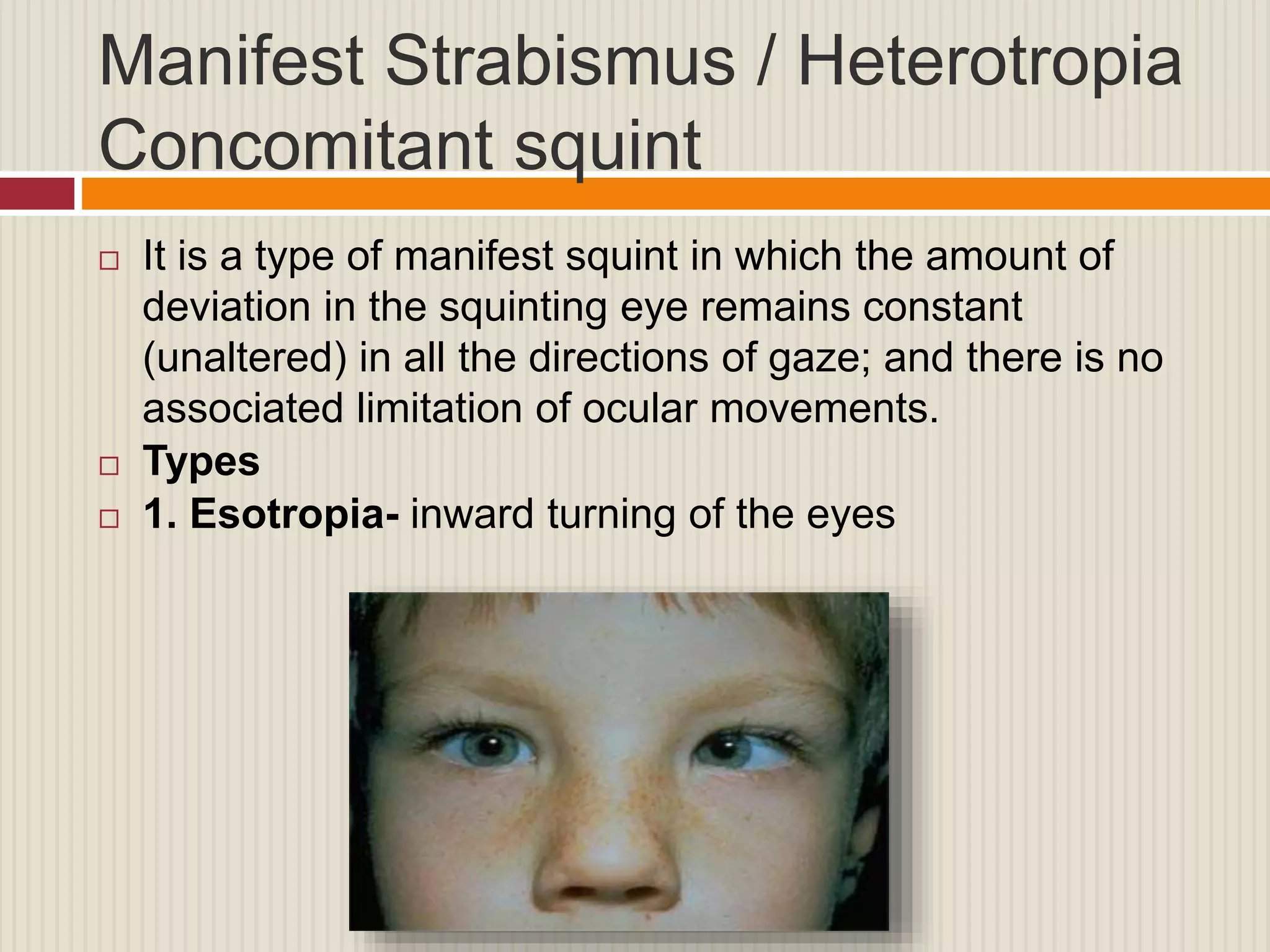 Evaluation of squint | PPTX