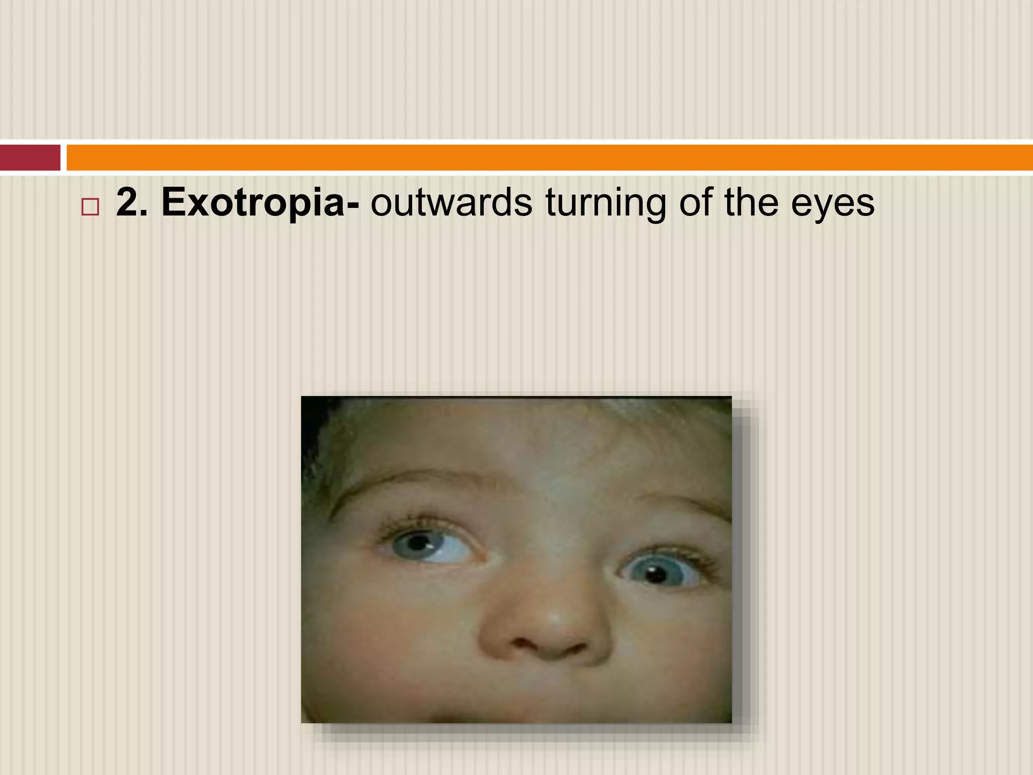 Evaluation of squint | PPTX