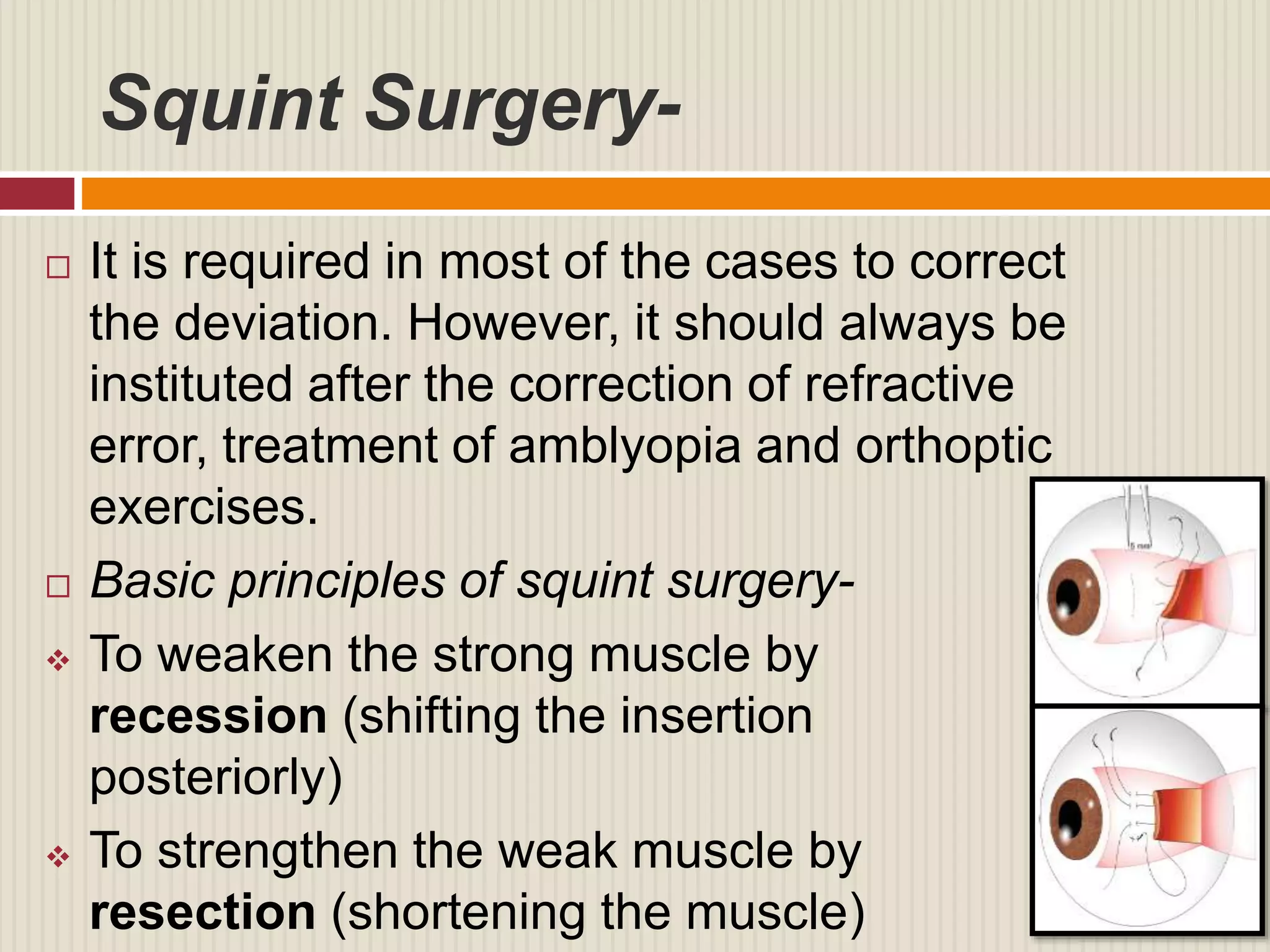 Evaluation of squint | PPTX