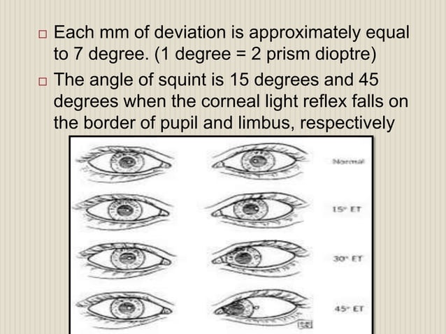 Evaluation of squint | PPTX
