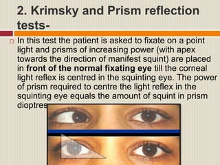 Evaluation of squint | PPTX