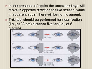 Evaluation of squint | PPTX