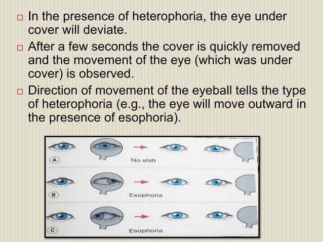 Evaluation of squint | PPTX