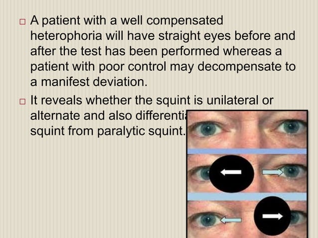 Evaluation of squint | PPTX