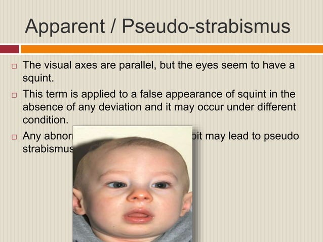 Evaluation of squint | PPTX