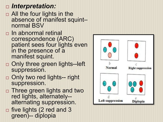 Evaluation of squint | PPTX