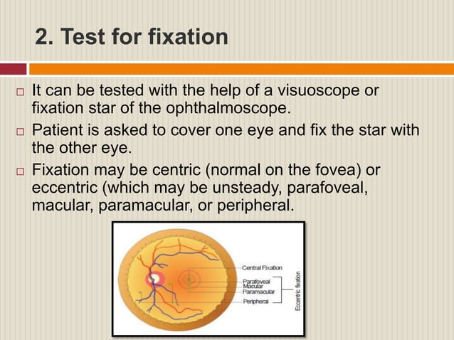 Evaluation of squint | PPTX