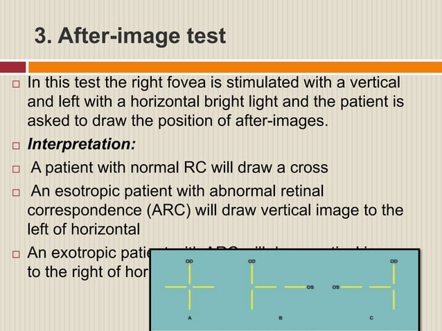 Evaluation of squint | PPTX