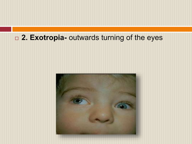 Evaluation of squint | PPTX