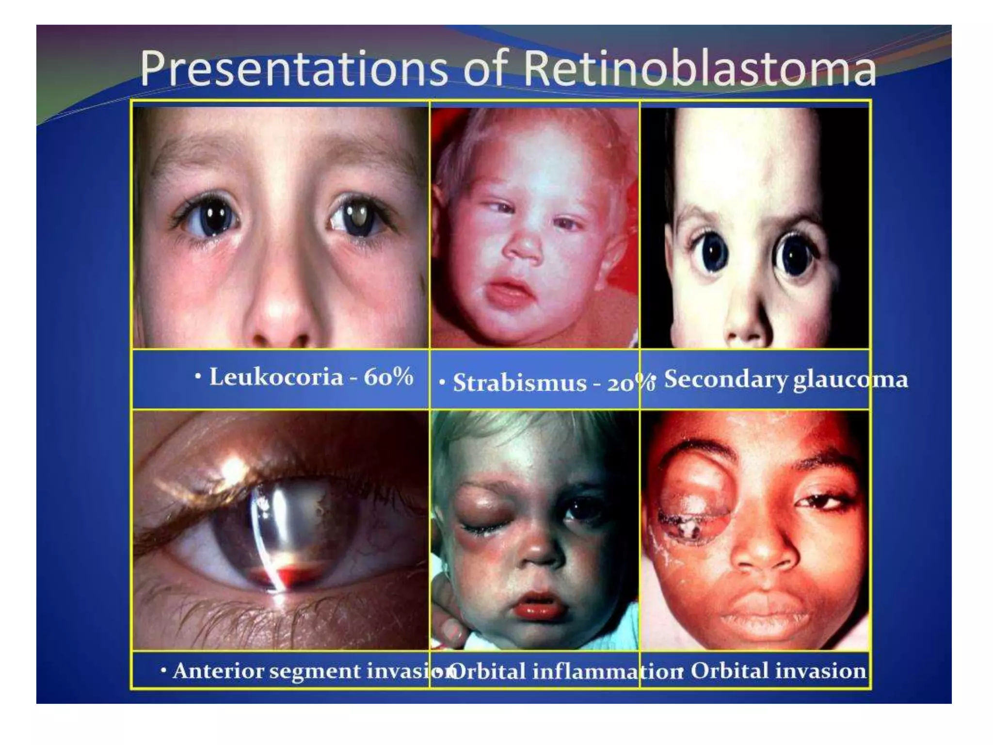 Evaluation of White Pupillary Reflex FINAL.pptx