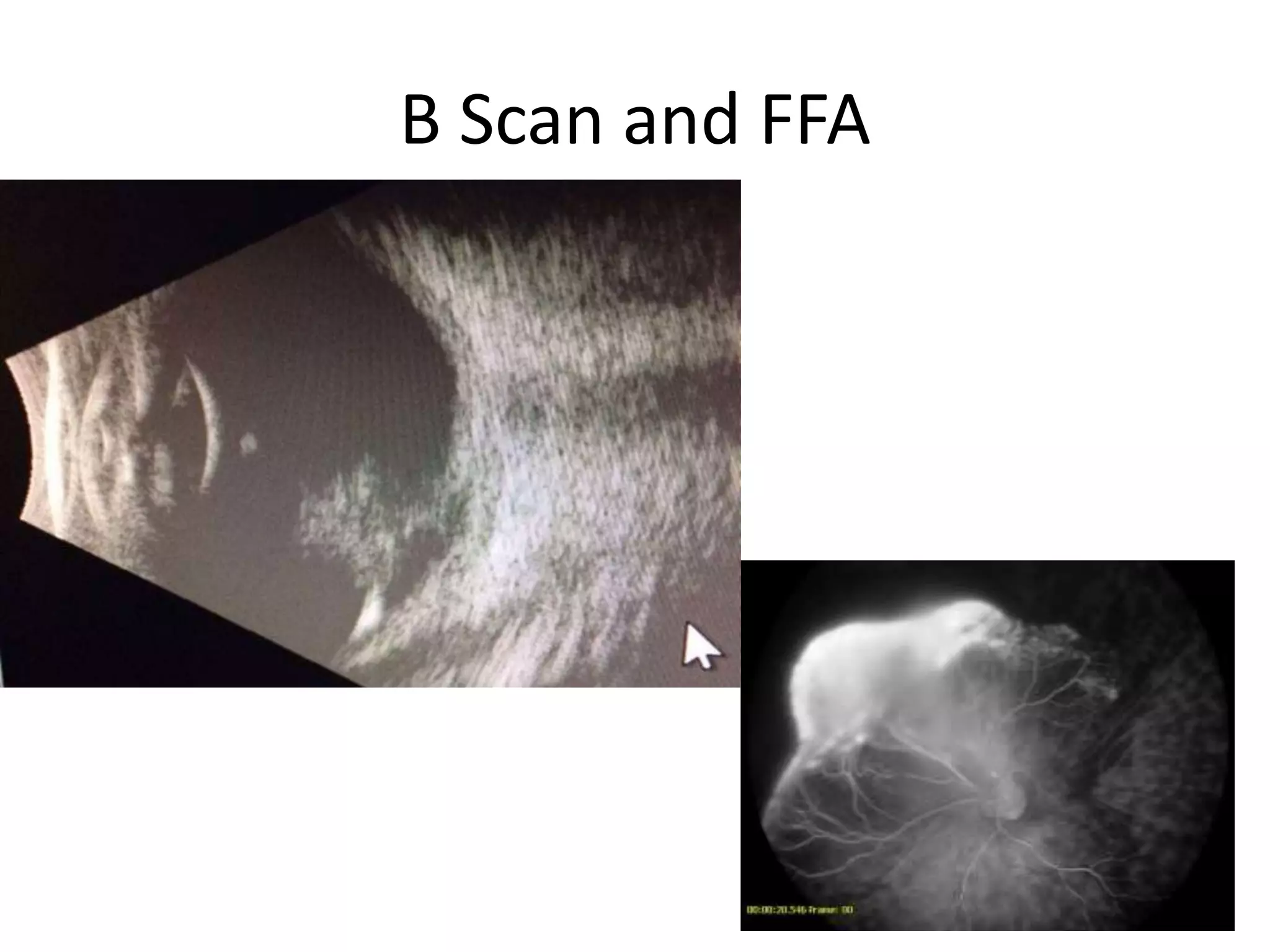 Evaluation of White Pupillary Reflex FINAL.pptx