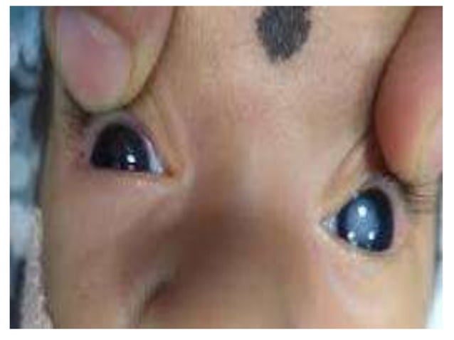 Evaluation of White Pupillary Reflex FINAL.pptx