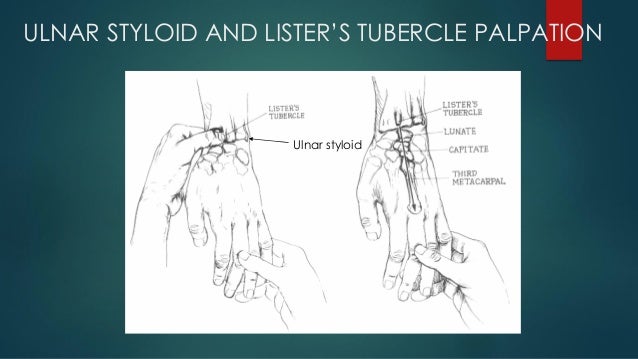 Ulnar Styloid Process Palpation Ulnar Styloid Fracture | Image