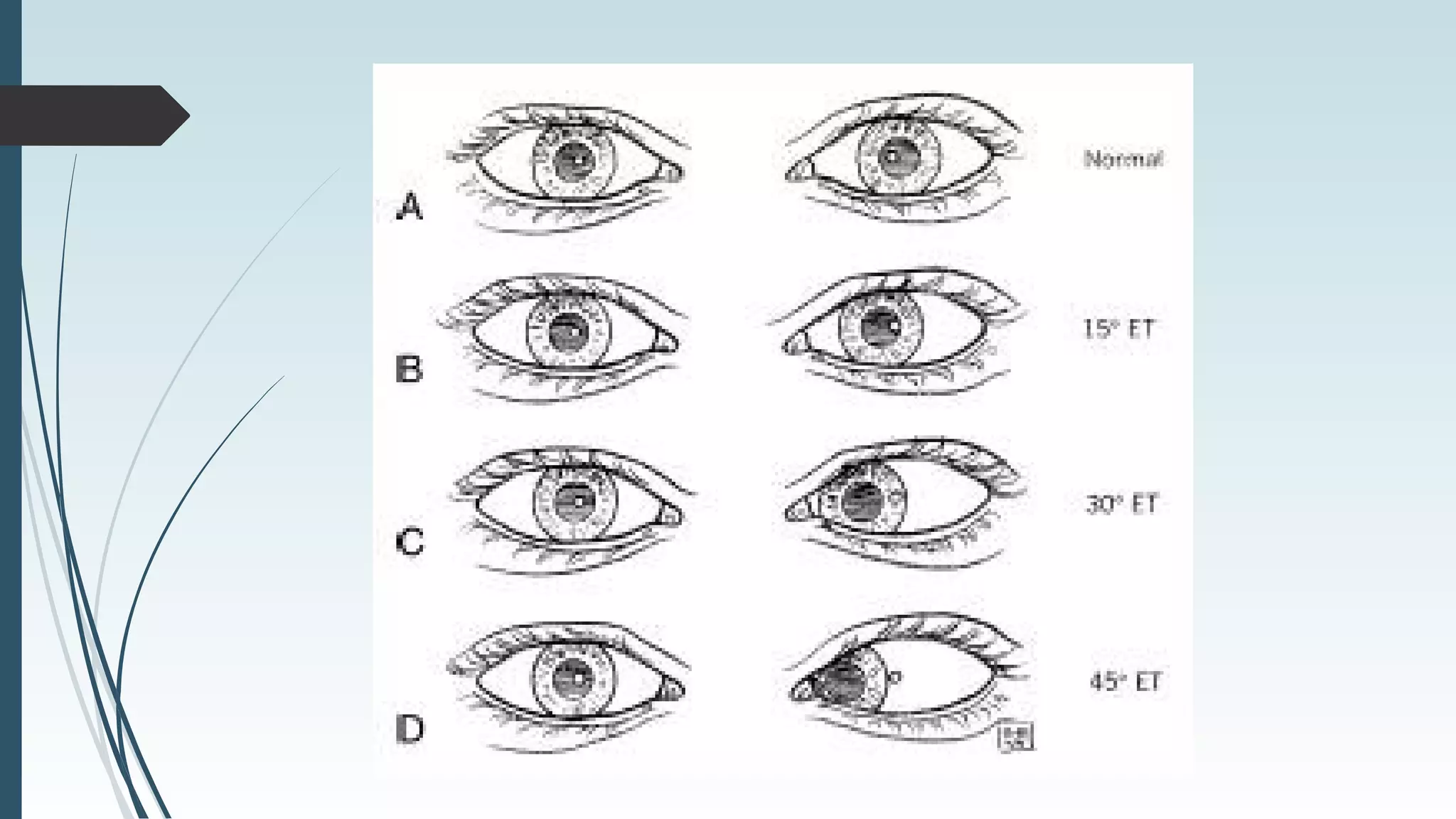 Evaluation of squint - The Basics | PPT