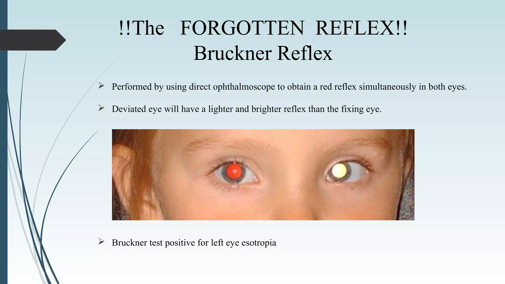 Evaluation of squint - The Basics | PPT