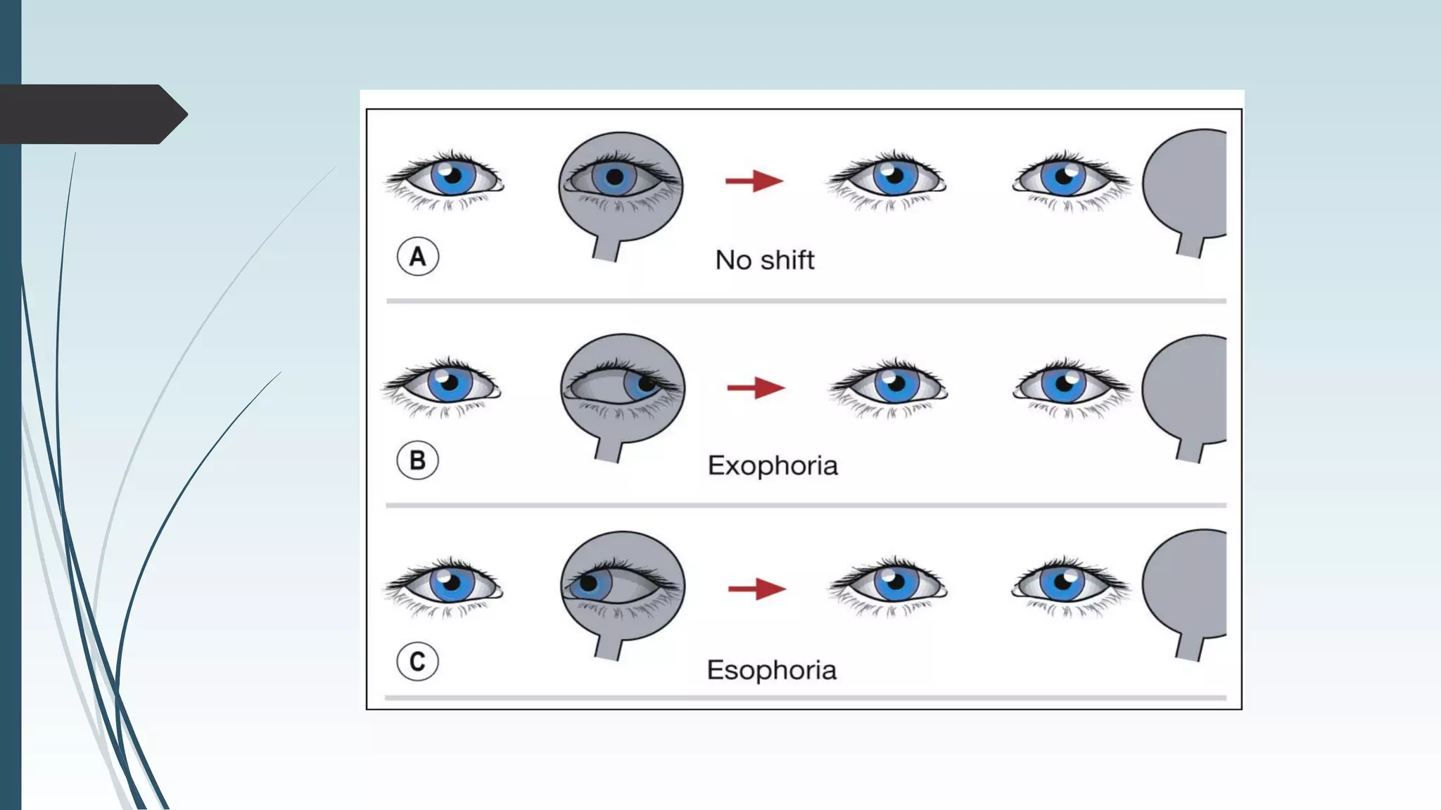 Evaluation of squint - The Basics | PPT
