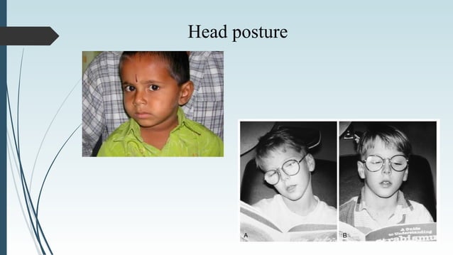 Evaluation of squint - The Basics | PPT | Eye and Vision Conditions ...