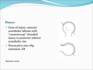 Femoroacetabular Impingment: Evidence Based Tratment | PPT