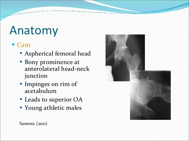 Femoroacetabular Impingment: Evidence Based Tratment