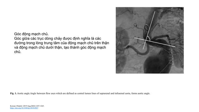 Endovascular Aneurysm Repair (EVAR).pptx