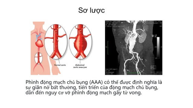 Endovascular Aneurysm Repair (EVAR).pptx