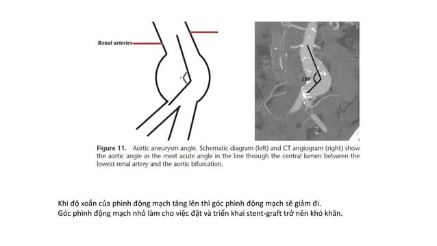 Endovascular Aneurysm Repair (EVAR).pptx