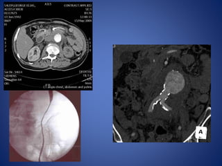 Evar in inflammatory aaa | PPT