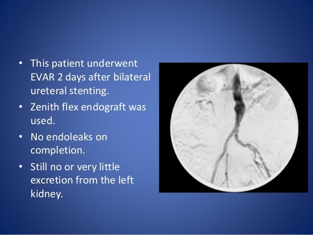 Evar in inflammatory aaa