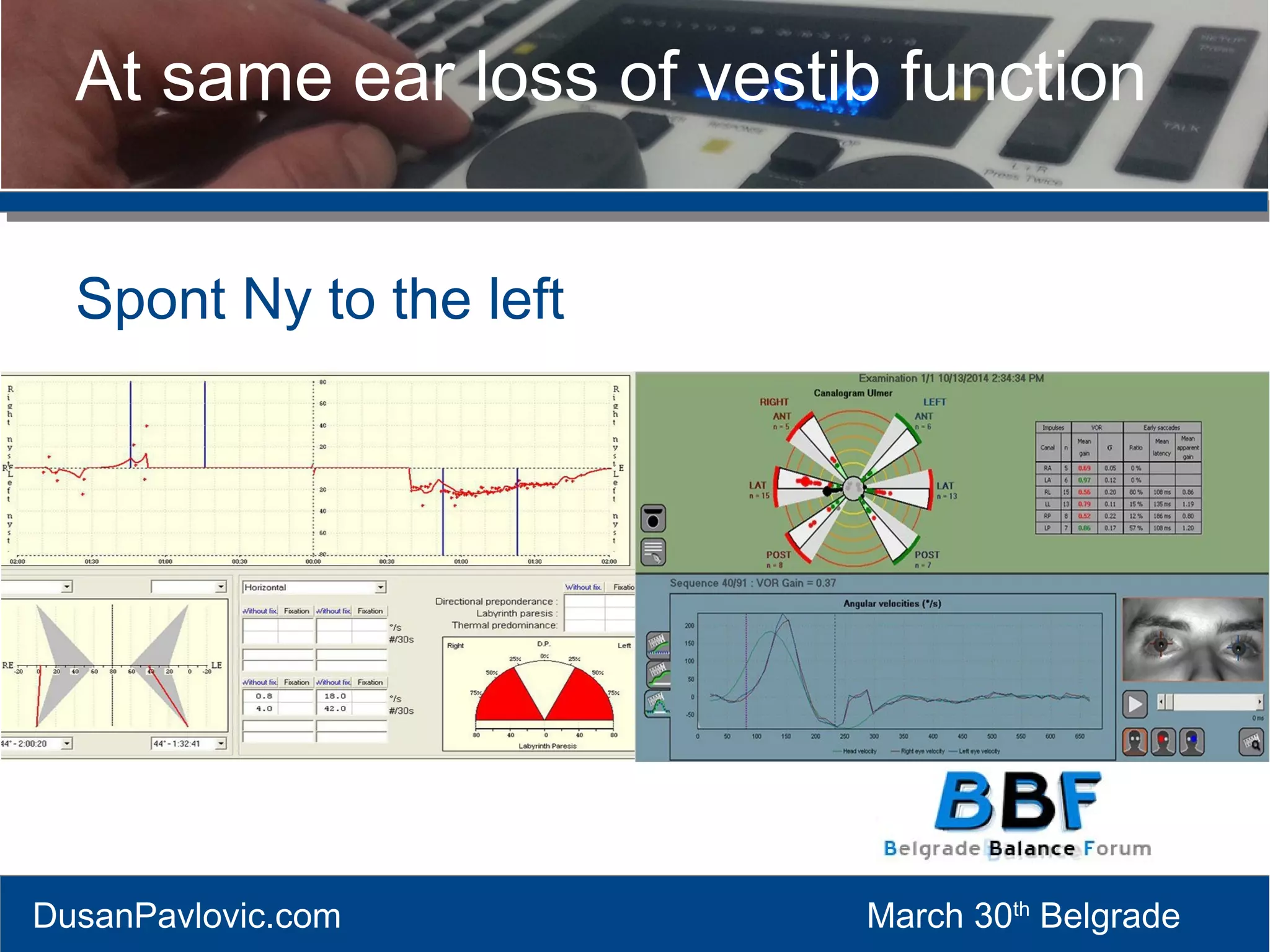 EVAS Enlarged Vestibular Aqueduct Syndrome | PPT