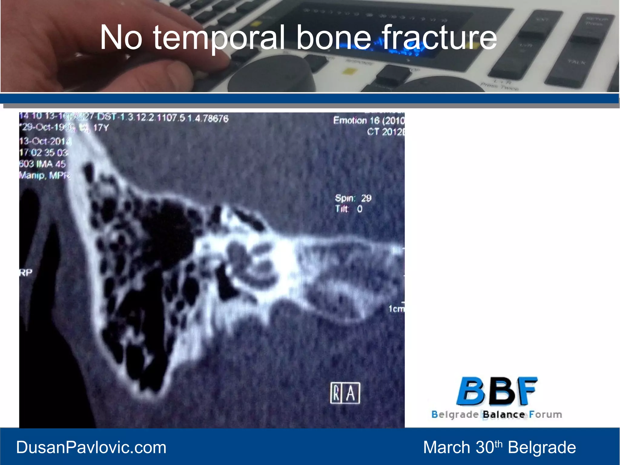 EVAS Enlarged Vestibular Aqueduct Syndrome | PPT