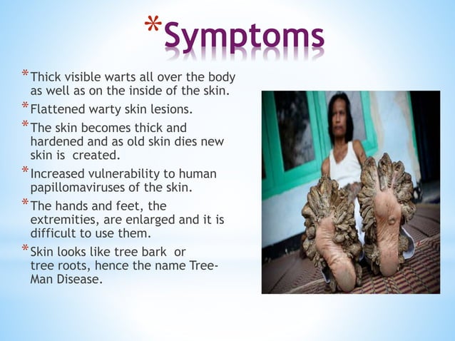 Tree-man disease (Epidermodysplasia Verruciformis) | PPTX | Cancer ...