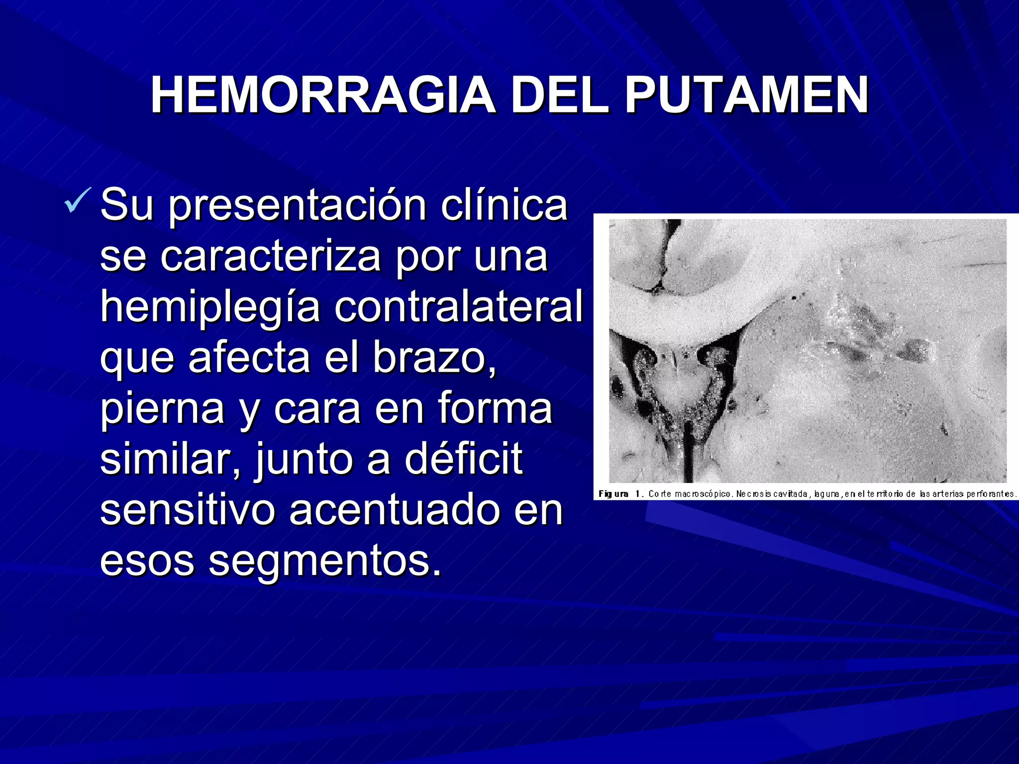 Evc Hemorragico | PPT