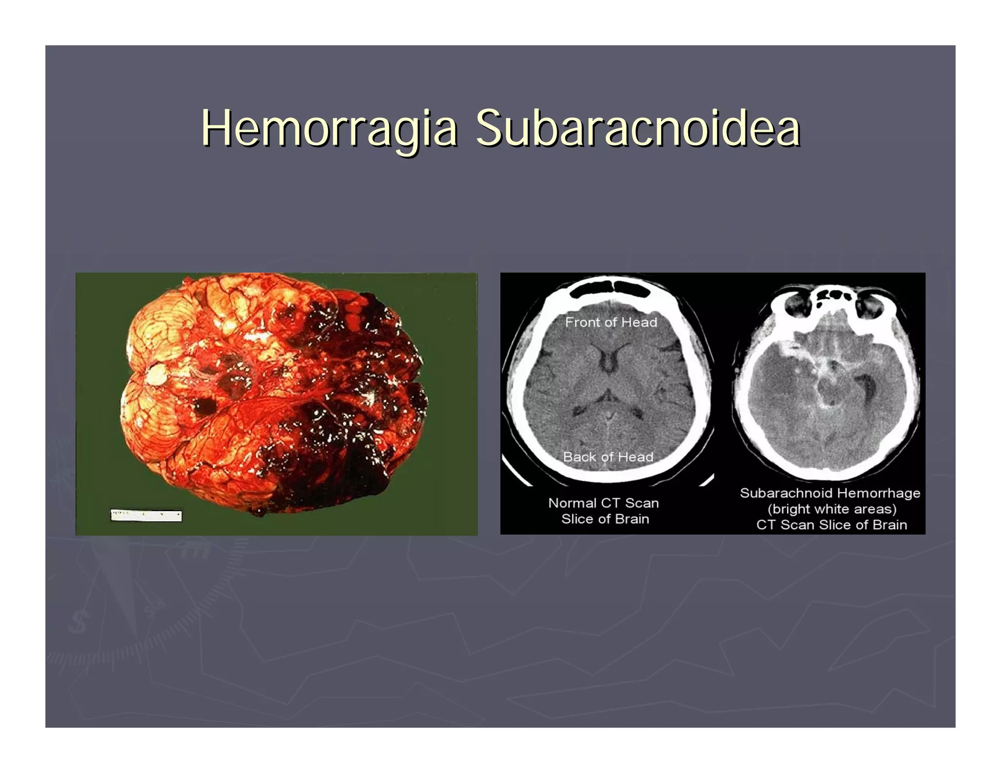 Evc Hemorragico | PDF