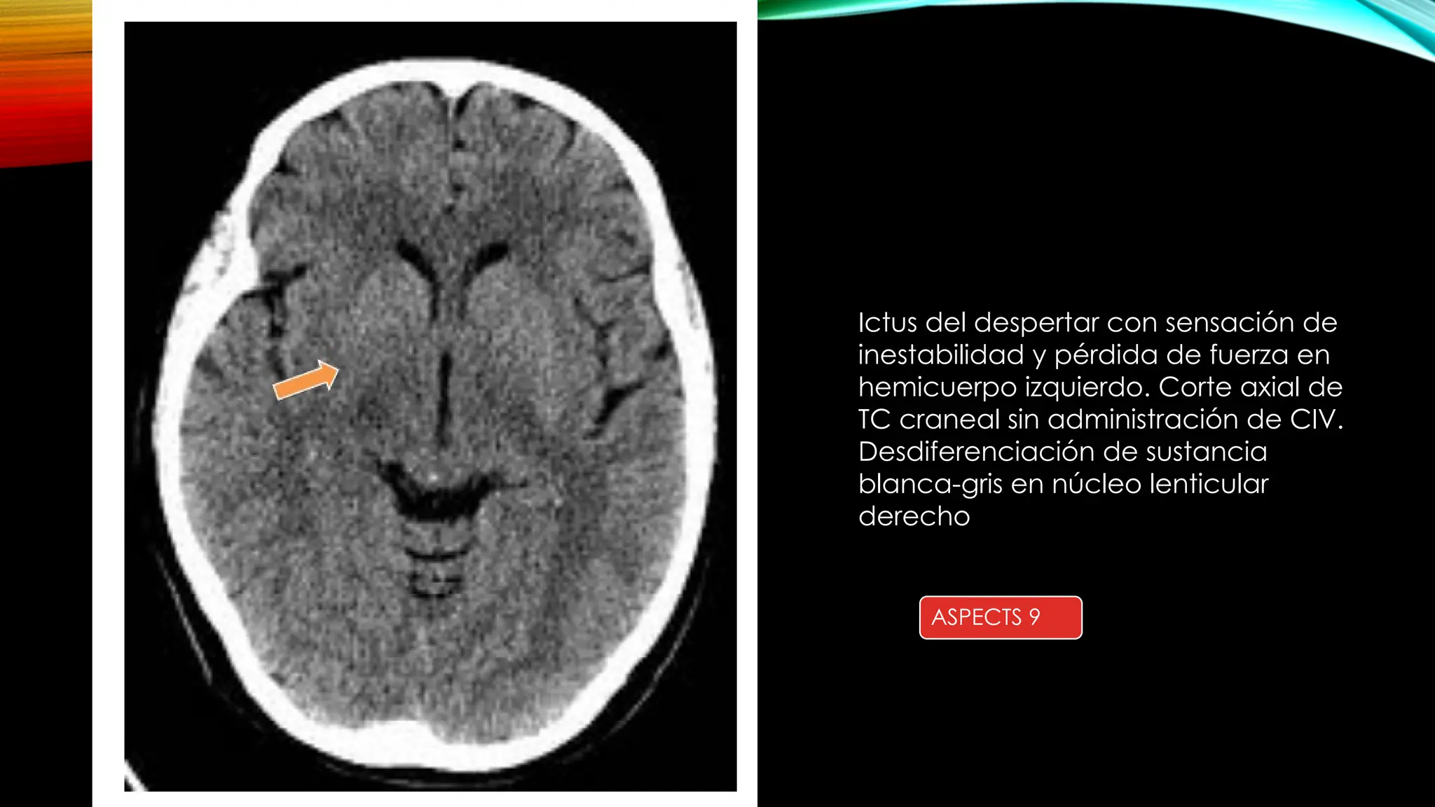 EVC ESCALA DE ASPECTS PARA EV ISQUEMICO, RIESGO BENEFICIO DE ...