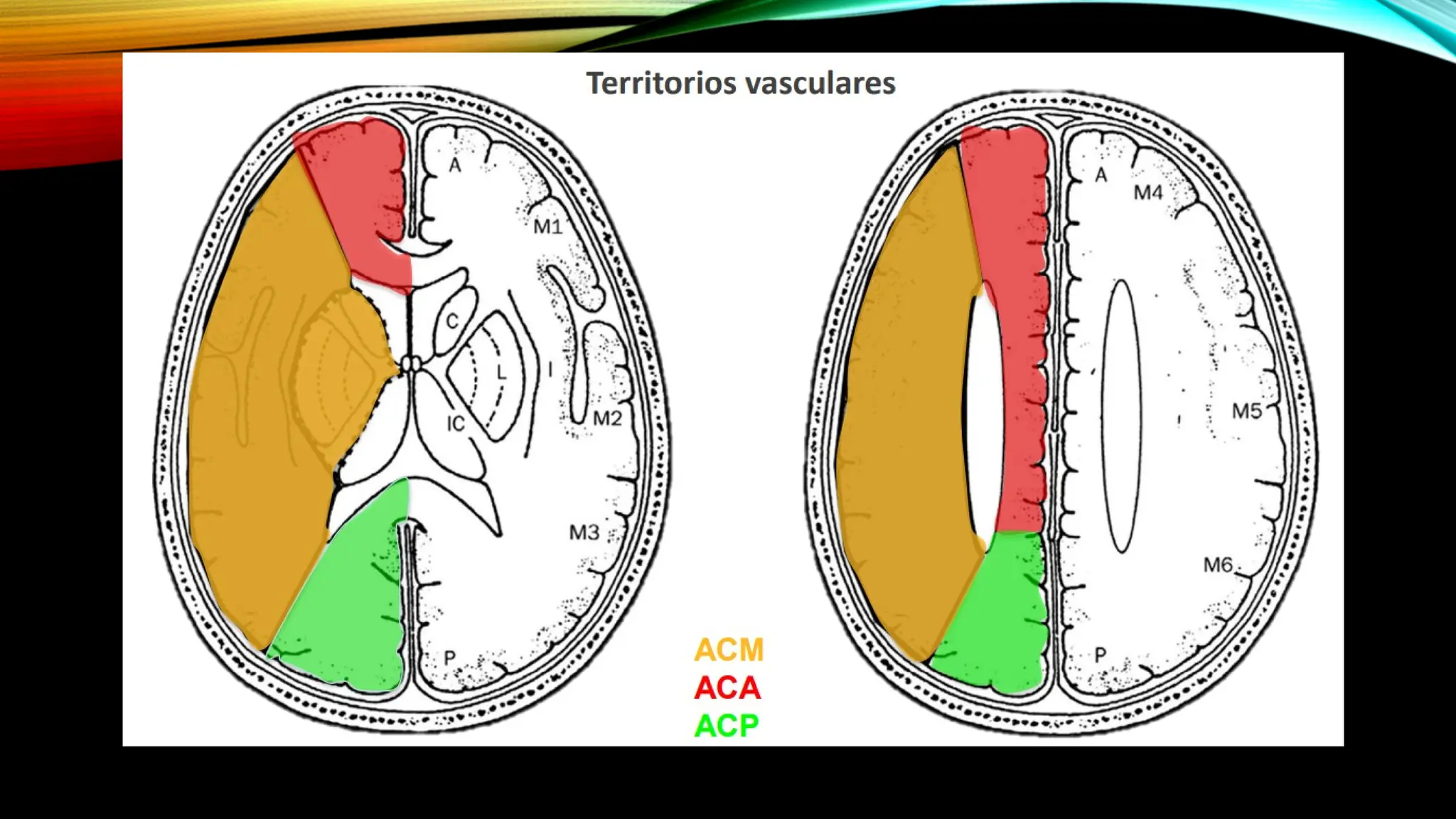 EVC ESCALA DE ASPECTS PARA EV ISQUEMICO, RIESGO BENEFICIO DE ...